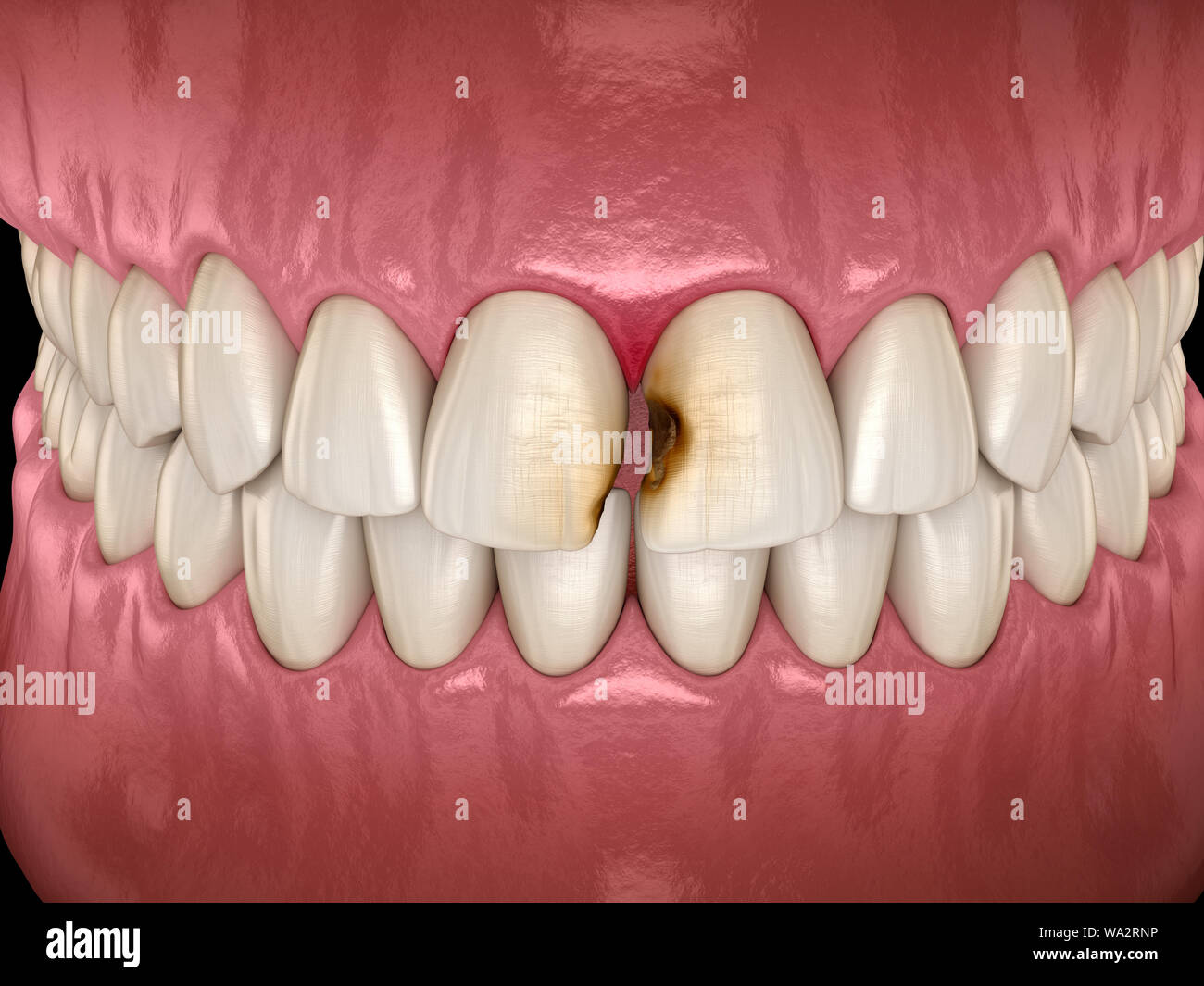 Central incisor teeth damaged by caries. Medically accurate tooth 3D ...