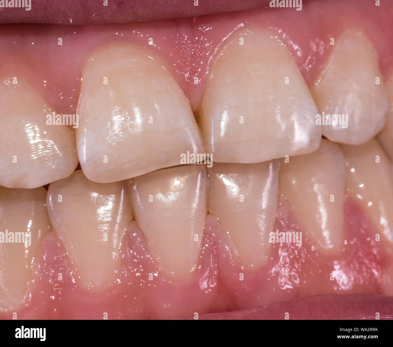 Healthy human teeth - incisors, frontal close up view Stock Photo - Alamy