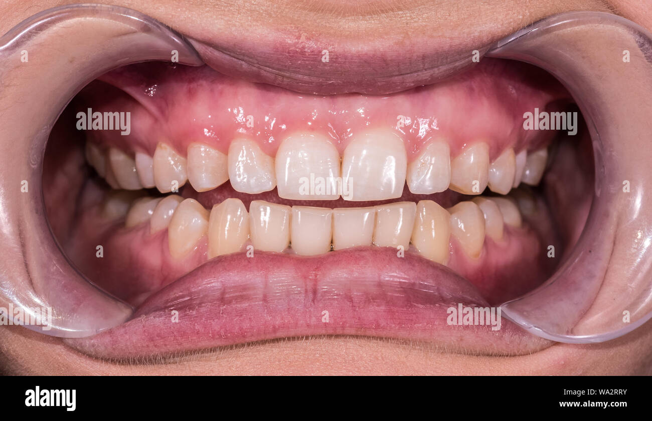Healthy human teeth with normal occlusion from frontal intraoral view ...