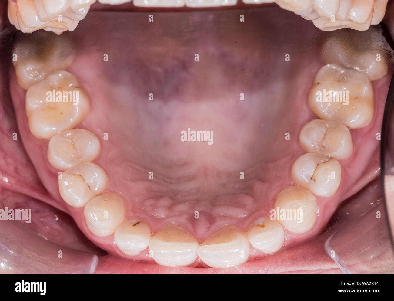 Healthy human teeth - incisors, frontal close up view Stock Photo - Alamy