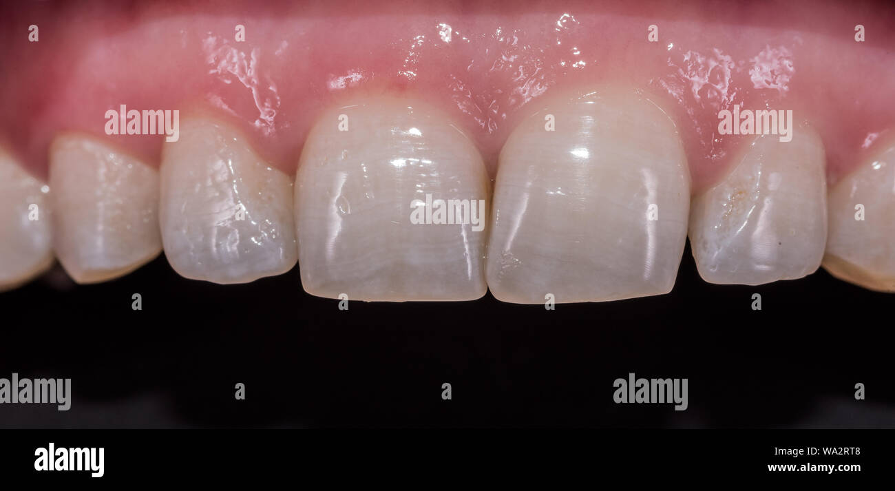 Healthy human teeth maxillary - frontal close up view Stock Photo - Alamy