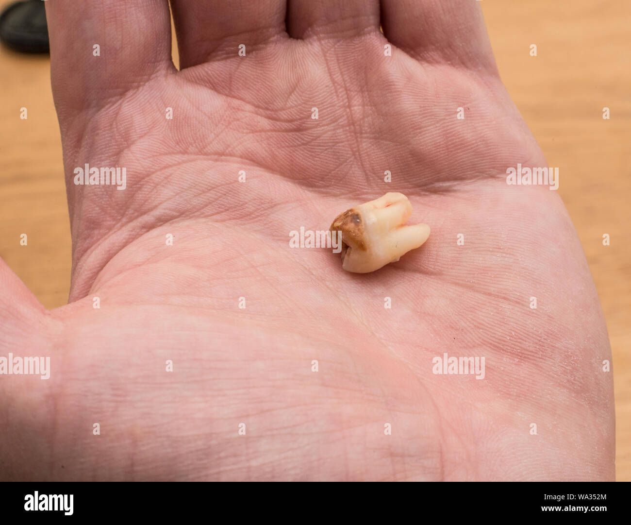 Pulled Teeth Stock Photos & Pulled Teeth Stock Images - Alamy
