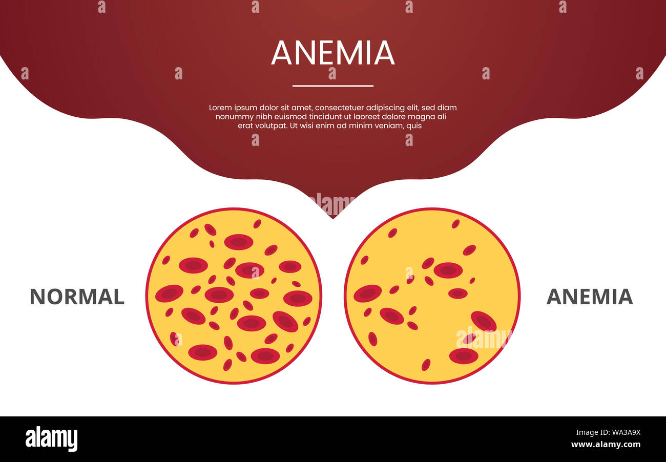 Normal anemia red blood cell hi-res stock photography and images - Alamy