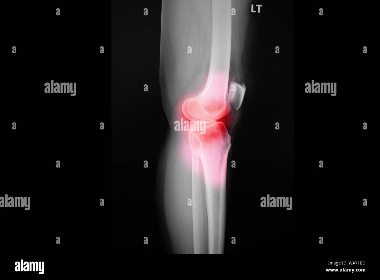 Osteoarthritis knee hi-res stock photography and images - Alamy