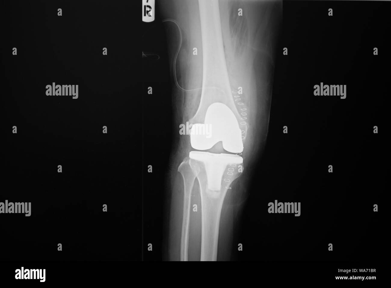 Total knee replacement x ray hi-res stock photography and images - Alamy