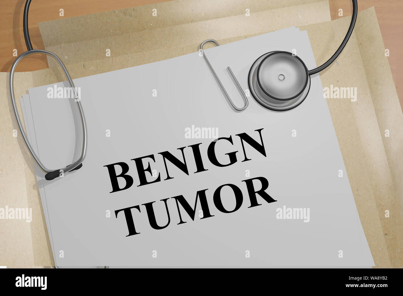 Benign neoplasm hi-res stock photography and images - Alamy