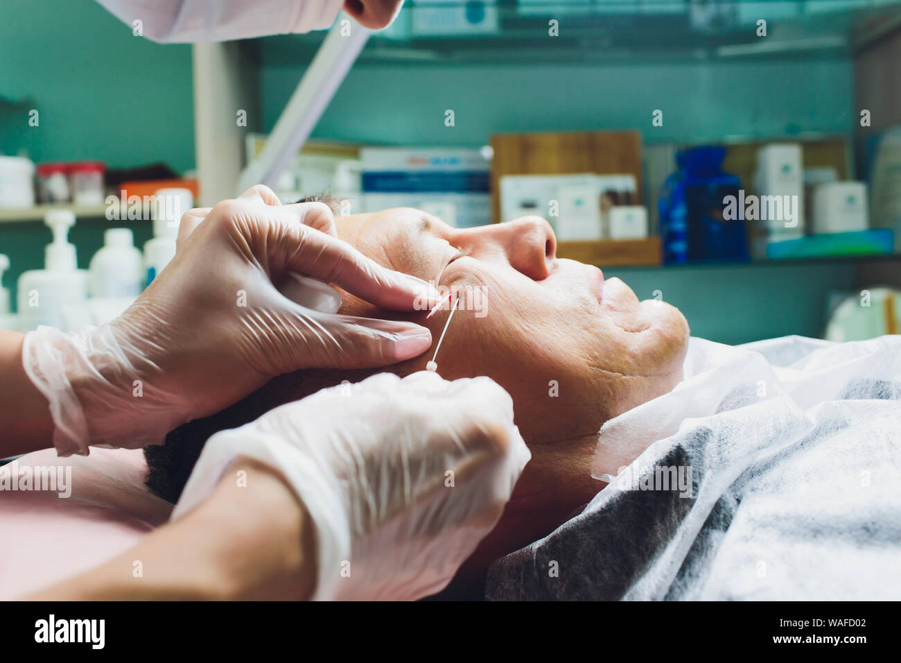 Close-up of procedure for face lifting PDO Suture operation, face ...