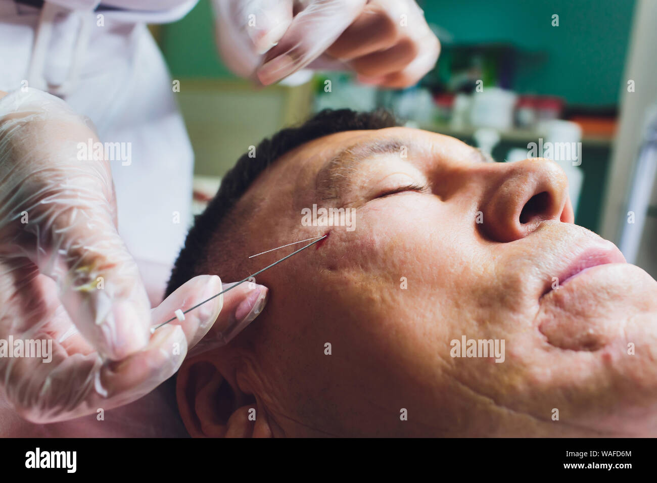 Close-up of procedure for face lifting PDO Suture operation, face ...