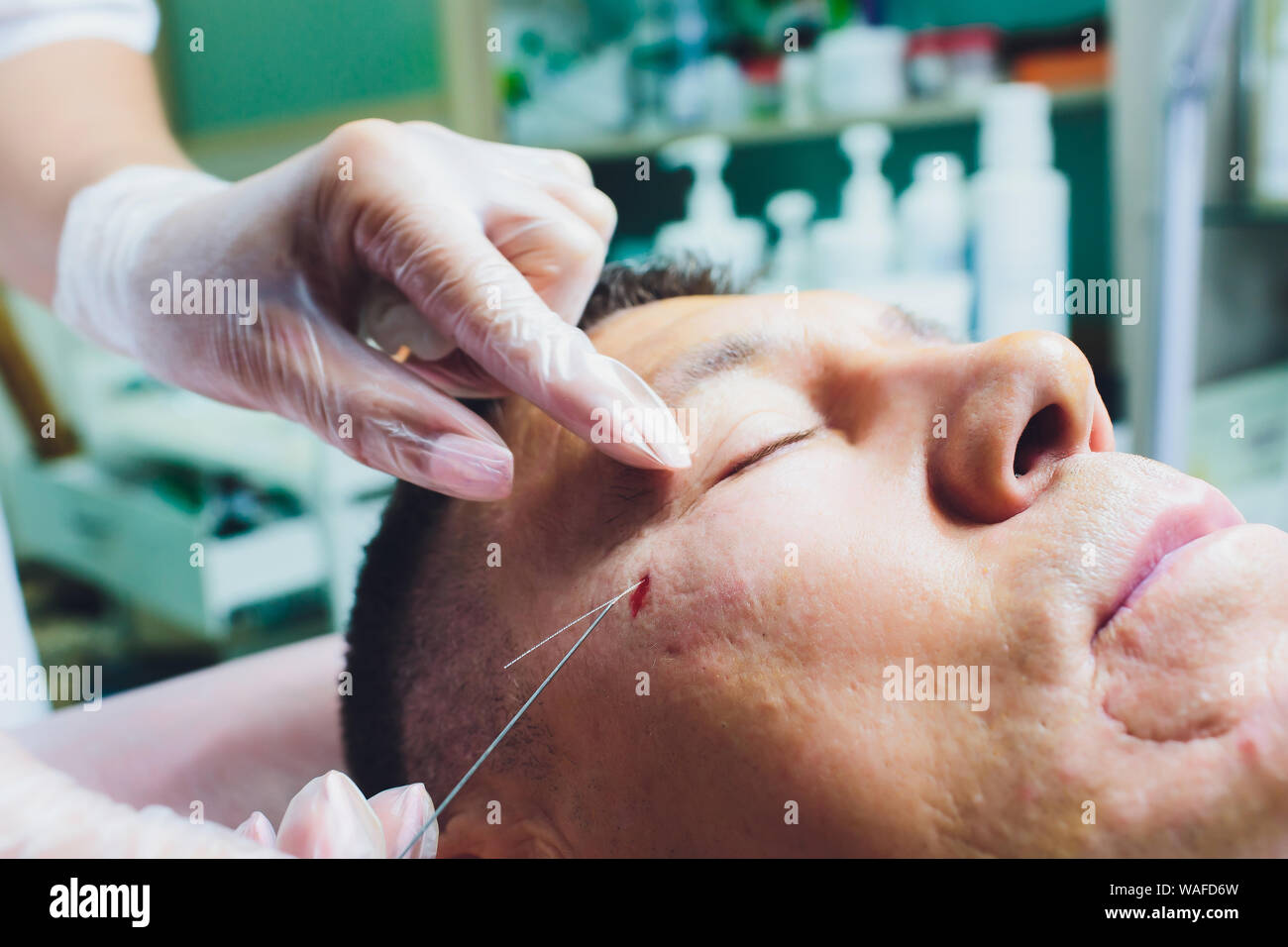 Close-up of procedure for face lifting PDO Suture operation, face ...