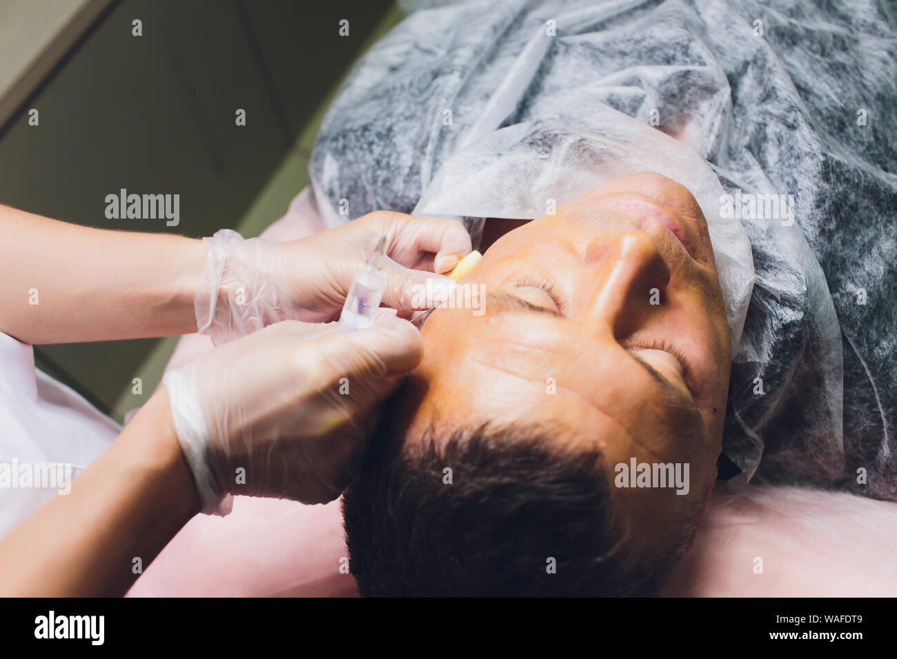 Close-up of procedure for face lifting PDO Suture operation, face ...