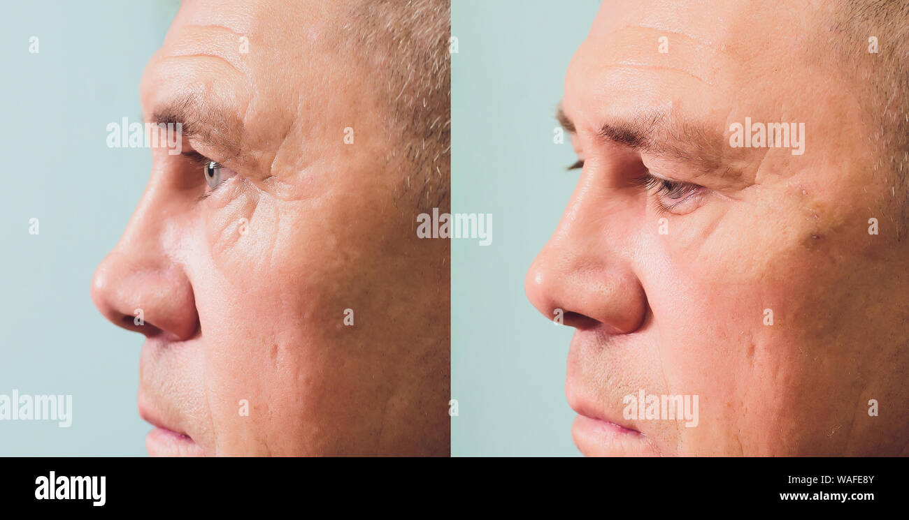 Close-up of procedure for face lifting PDO Suture operation, face ...