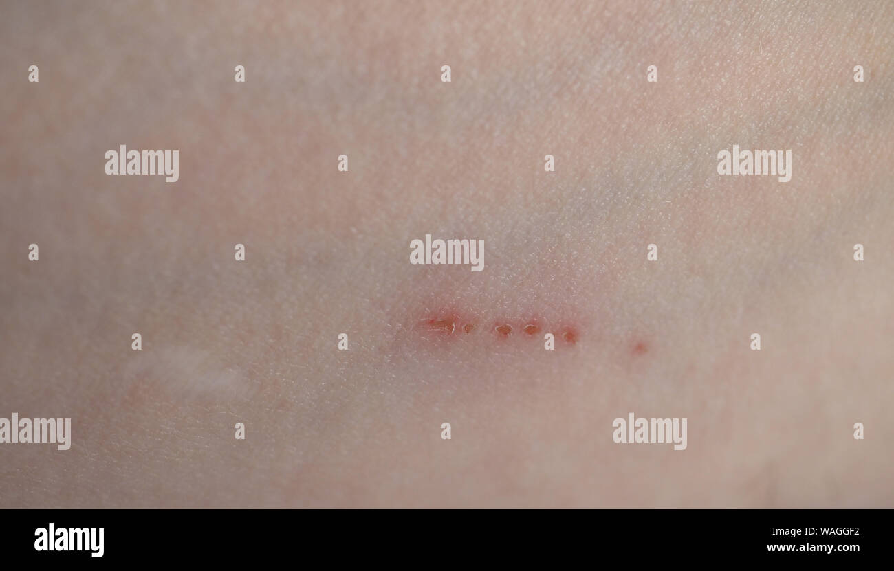 scratch scar on human arm caused by minor injury Stock Photo - Alamy