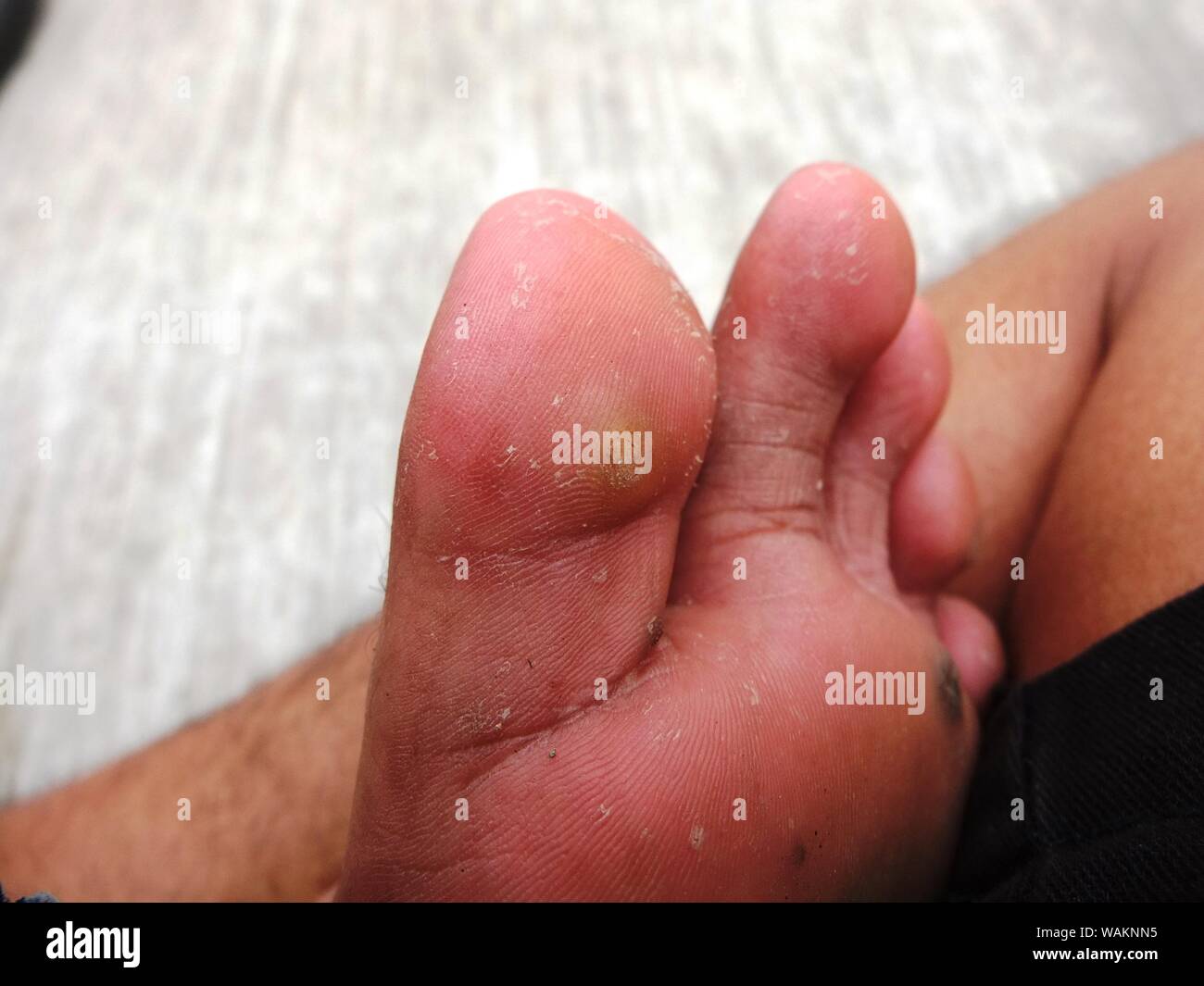 clavus disease in the soles of the feet Stock Photo - Alamy
