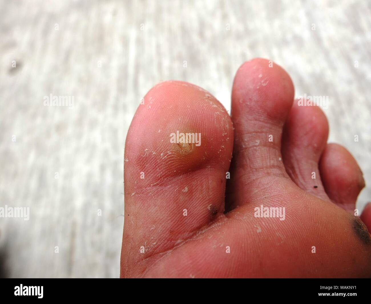 Pressure ulcer treatment hi-res stock photography and images - Alamy