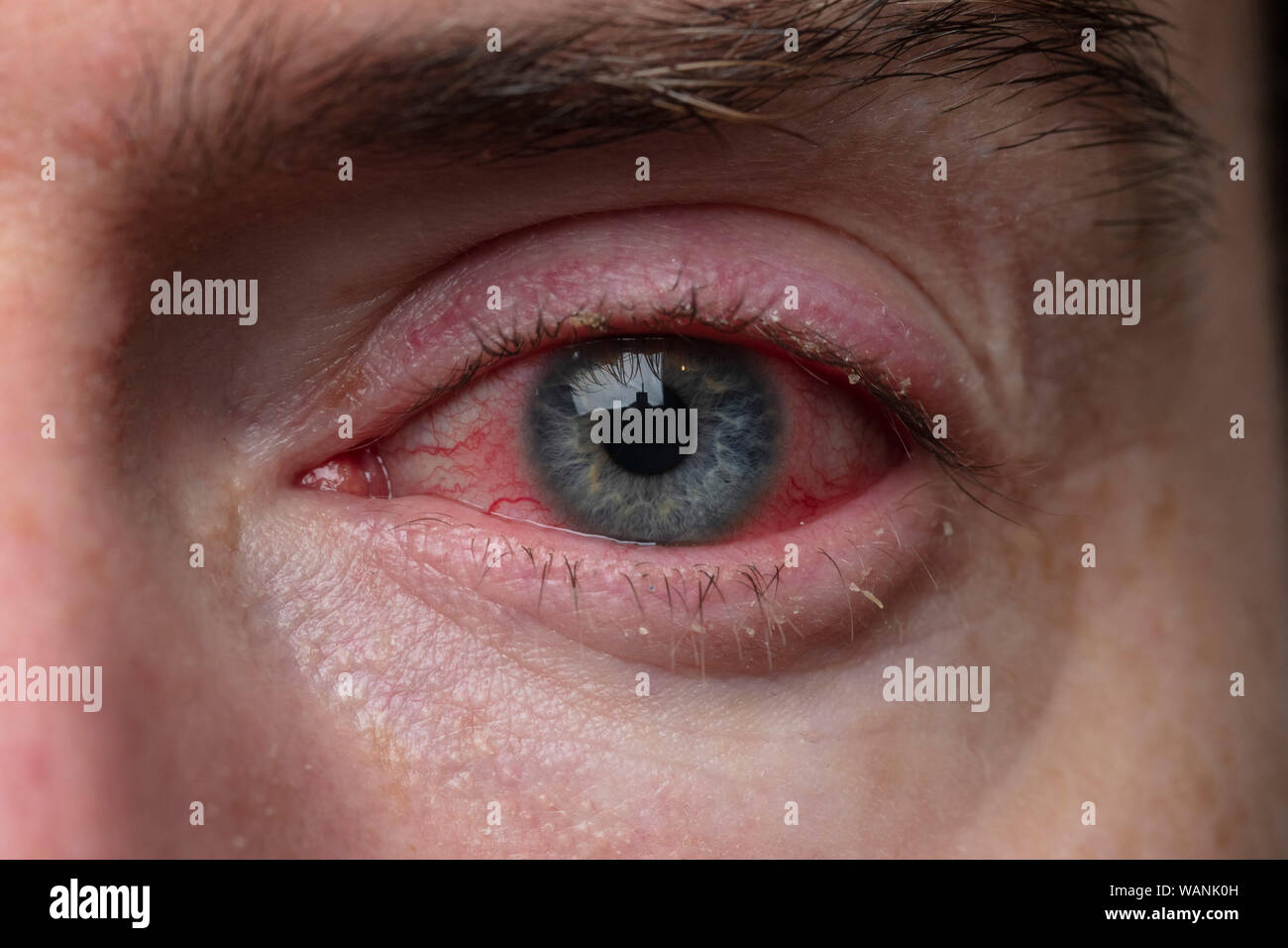 Allergic conjunctivitis hi-res stock photography and images - Alamy
