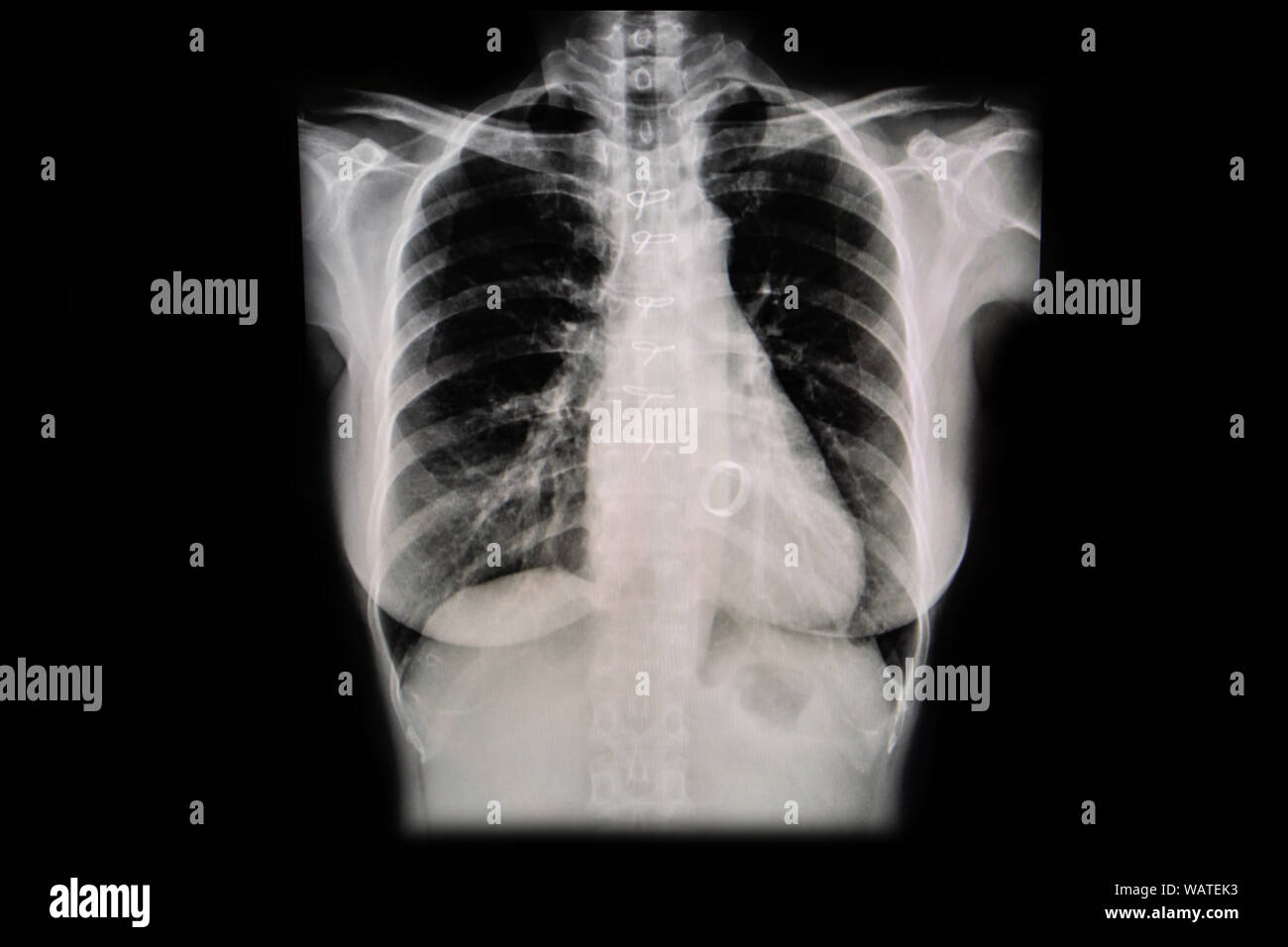 Normal chest x ray hi-res stock photography and images - Alamy