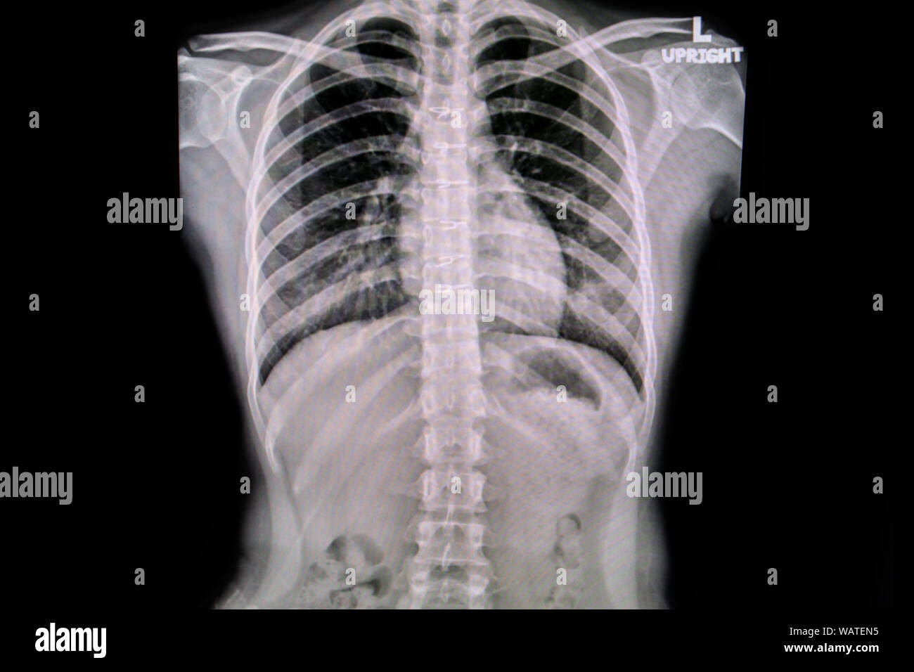 Normal chest x ray hi-res stock photography and images - Alamy