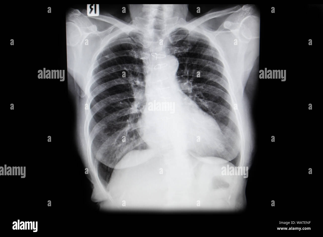 Heart X Ray High Resolution Stock Photography and Images - Alamy