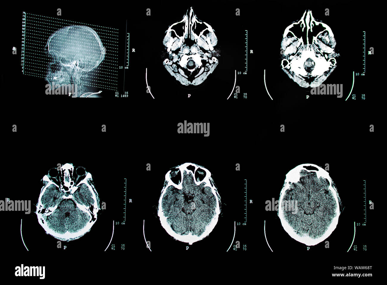 tomographic examination x-ray picture of a human head Stock Photo - Alamy