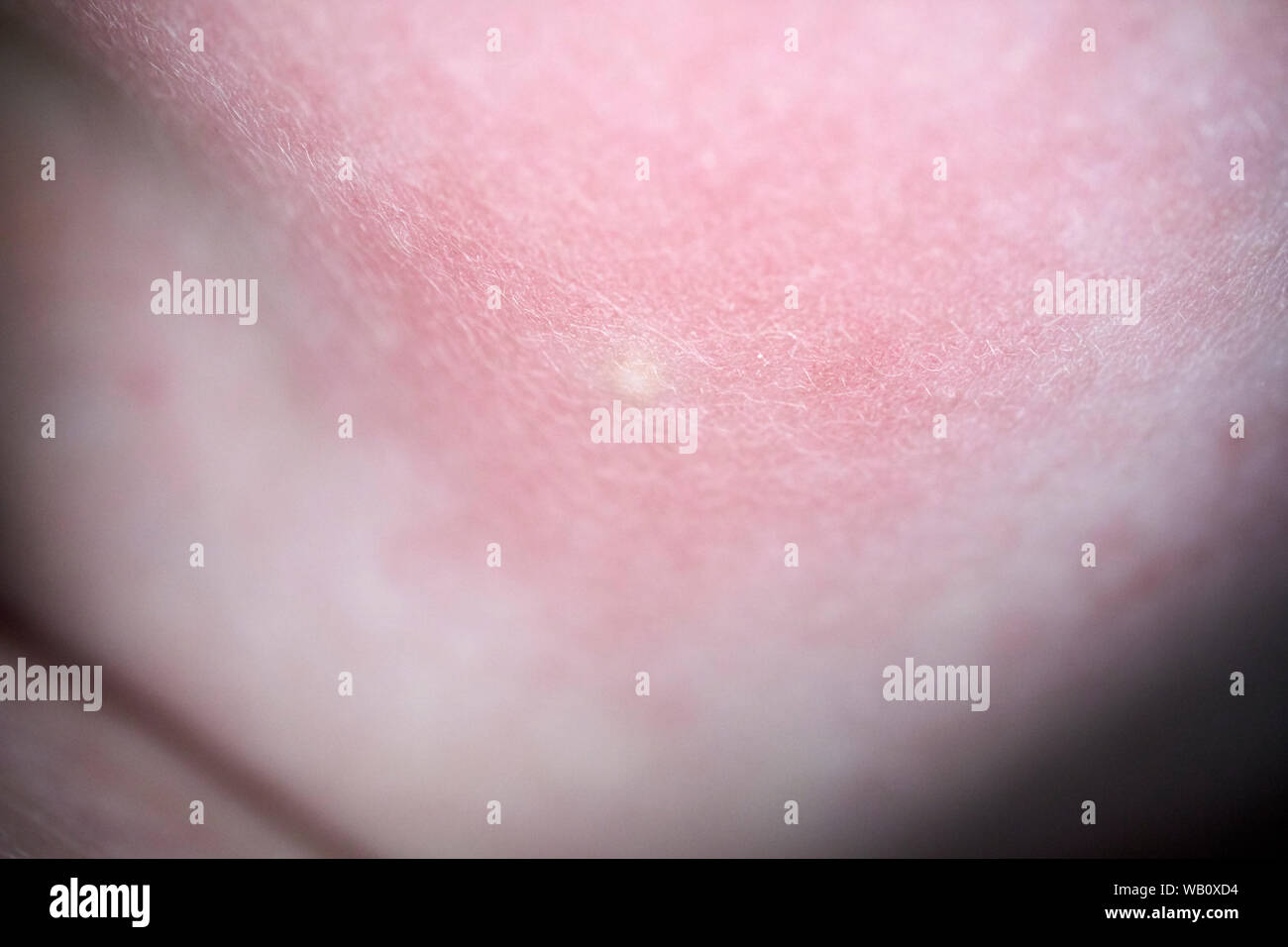 reddening and inflammation above a wasp sting on the face of a five ...