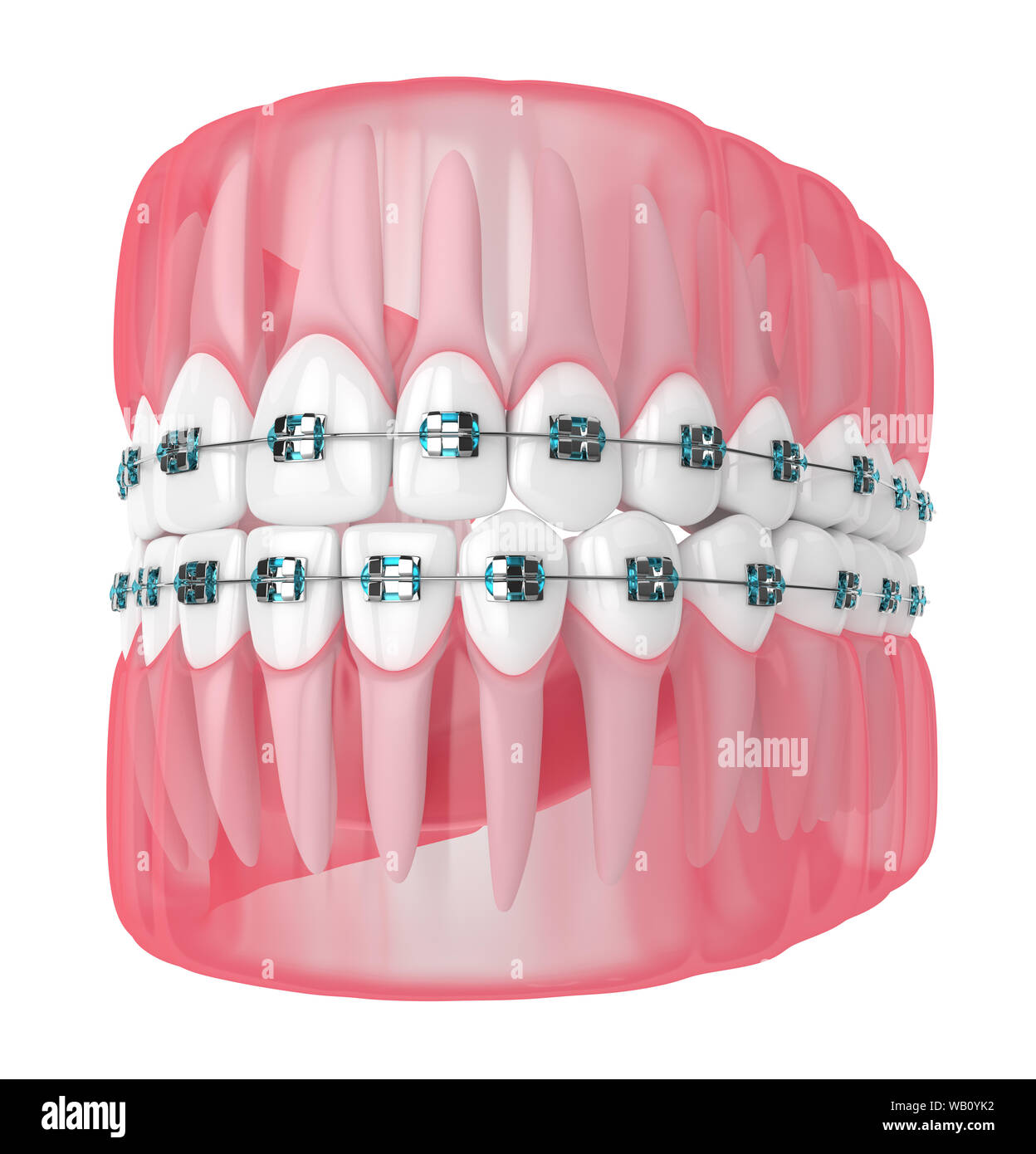 3d render of jaw with teeth and orthodontic braces isolated over white ...