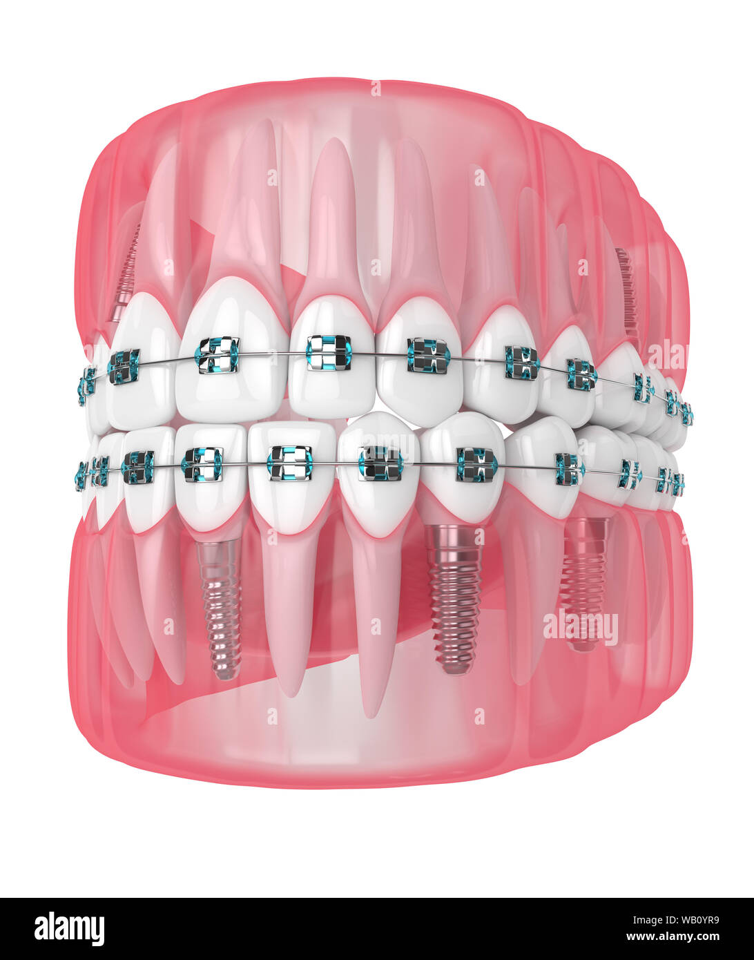 3d render of jaw with implants and orthodontic braces isolated over ...