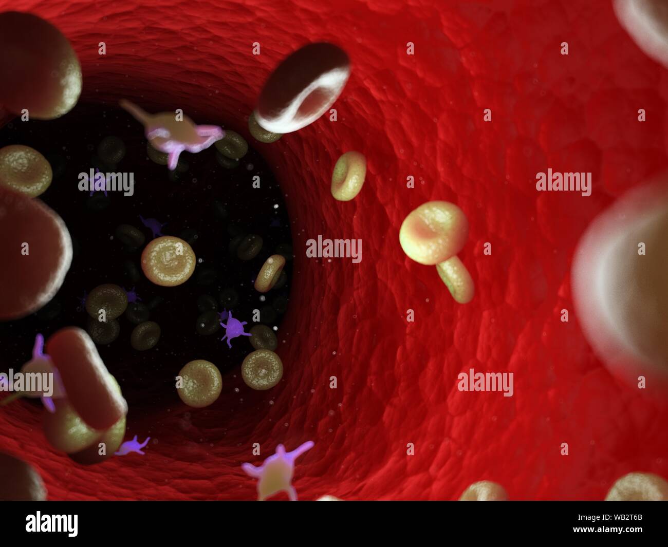 Diseased blood cells, computer illustration Stock Photo - Alamy