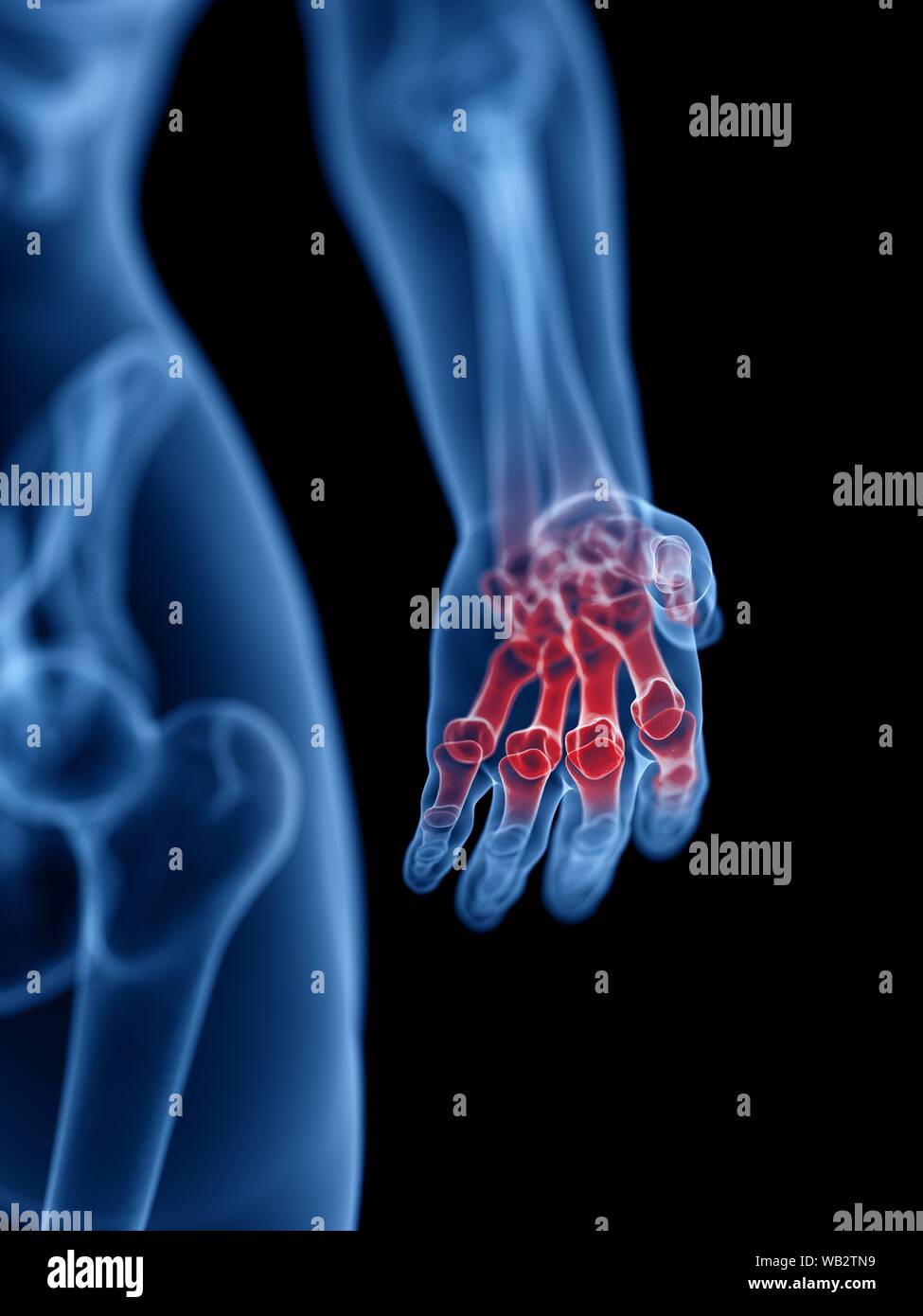 Hand pain, conceptual illustration Stock Photo - Alamy
