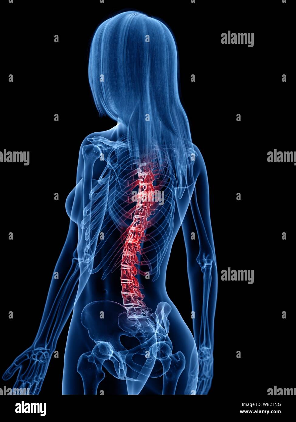 Back pain, conceptual illustration Stock Photo - Alamy