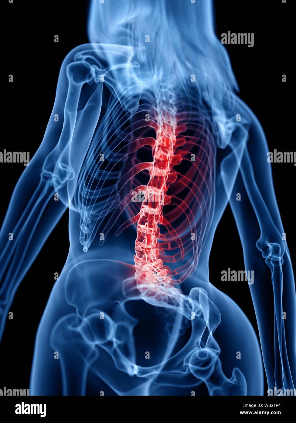 Back pain, conceptual illustration Stock Photo - Alamy