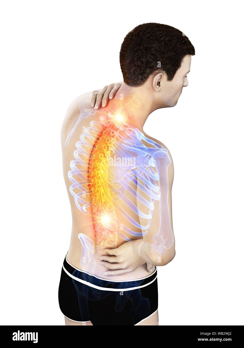 Back pain, conceptual illustration Stock Photo - Alamy