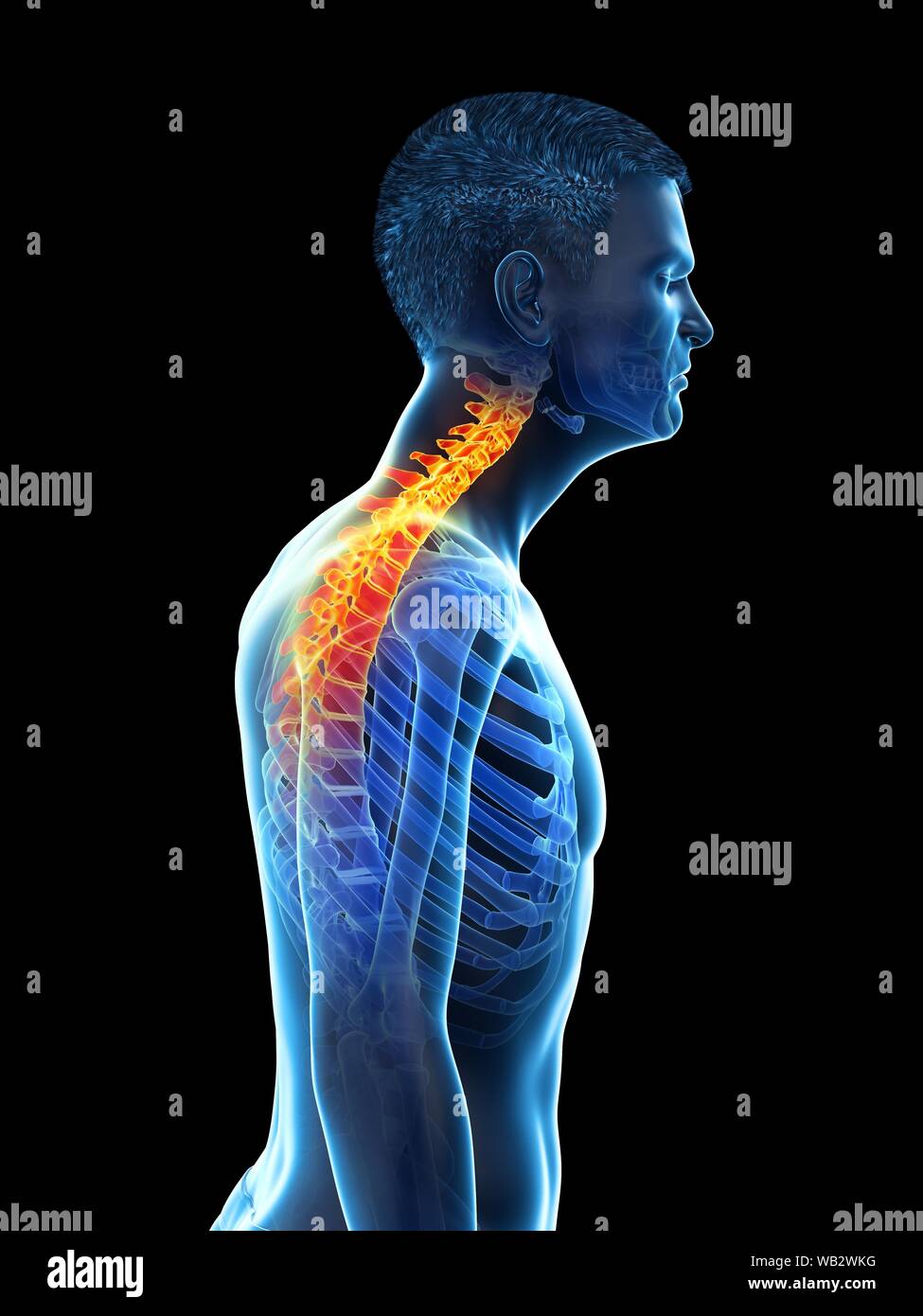 Neck pain, conceptual illustration Stock Photo - Alamy