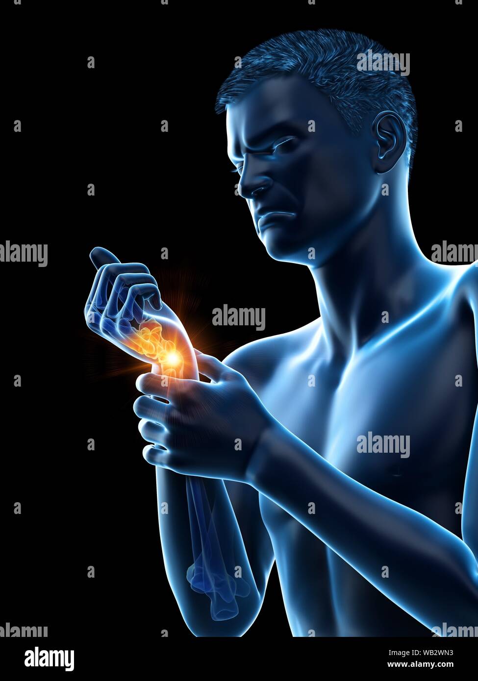 Wrist pain, conceptual illustration Stock Photo - Alamy