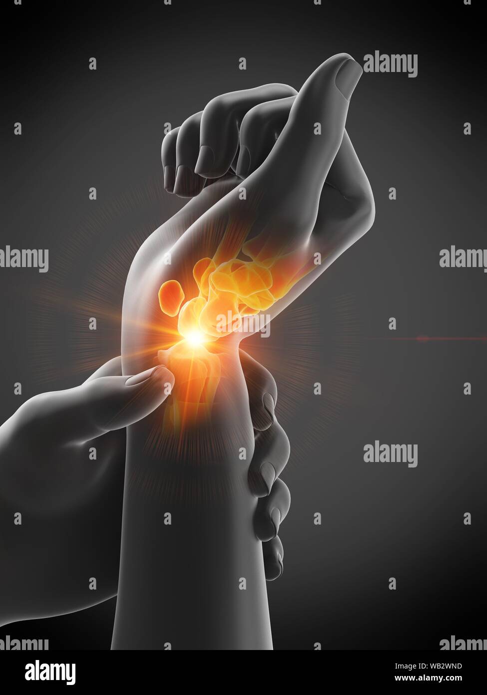 Wrist pain, conceptual illustration Stock Photo - Alamy