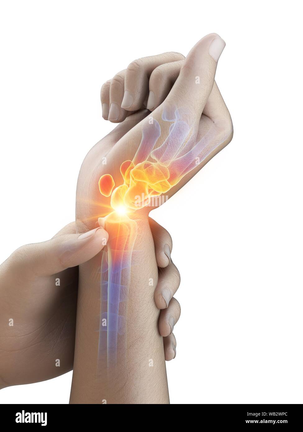 Wrist pain, conceptual illustration Stock Photo - Alamy