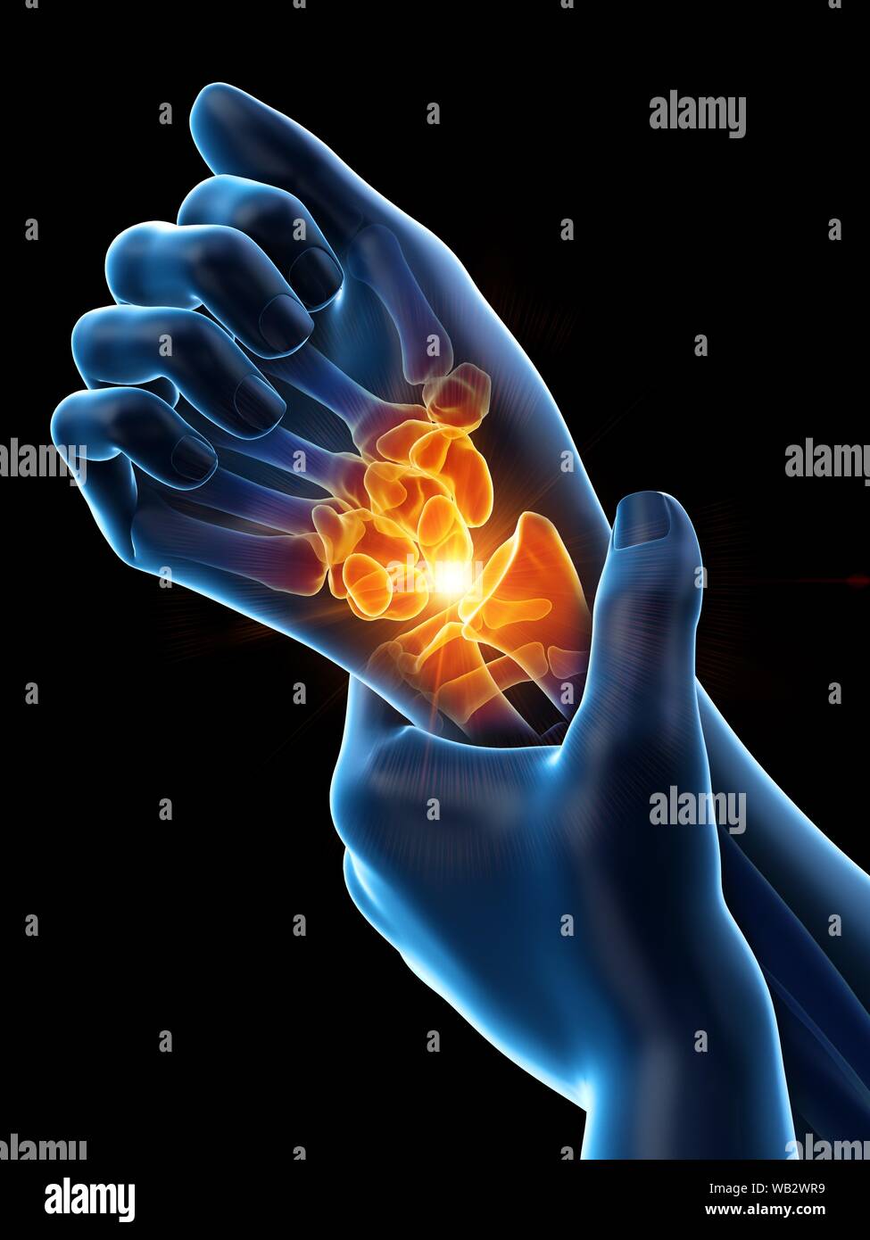 Wrist pain, conceptual illustration Stock Photo - Alamy