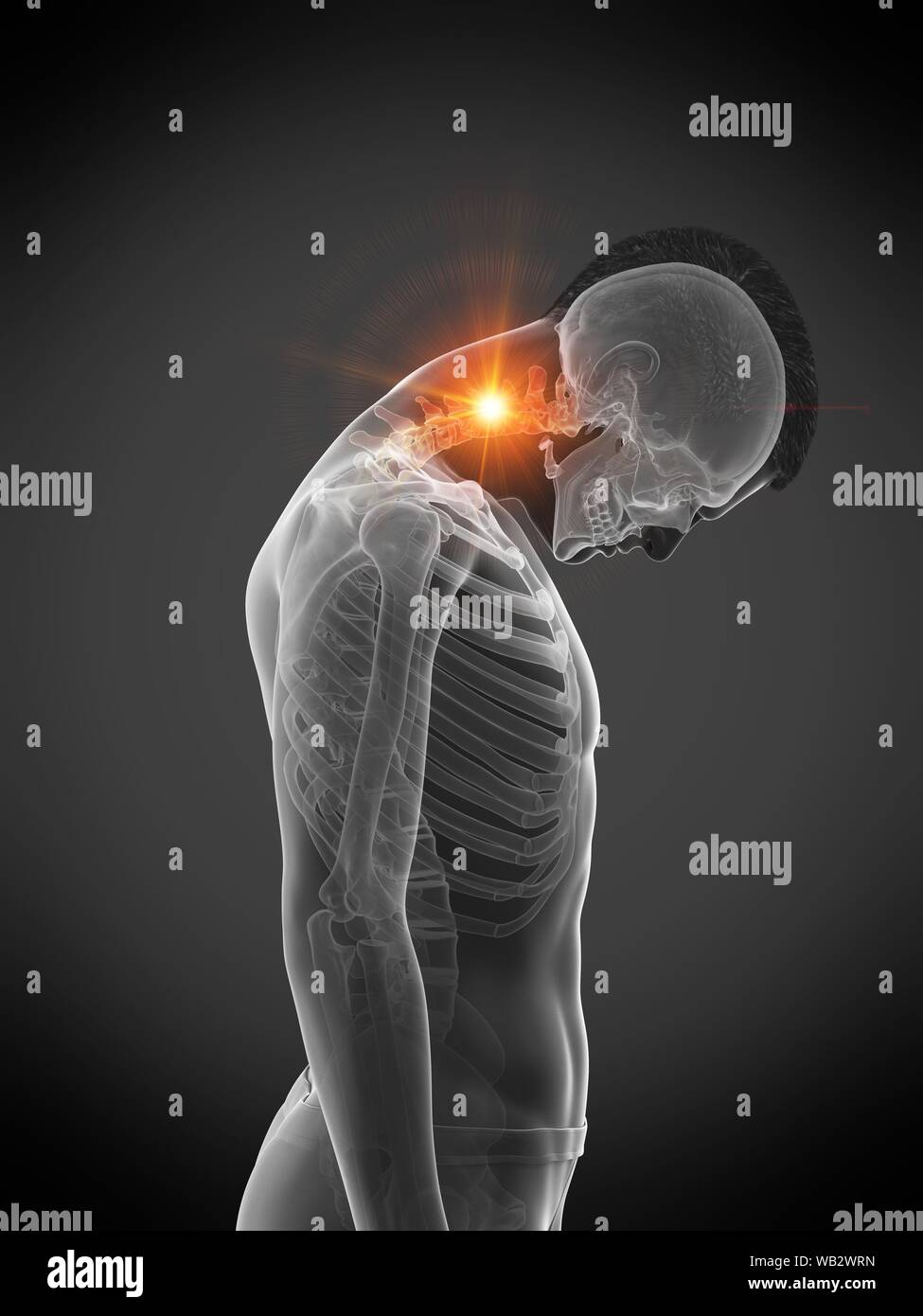 Neck pain, conceptual illustration Stock Photo - Alamy
