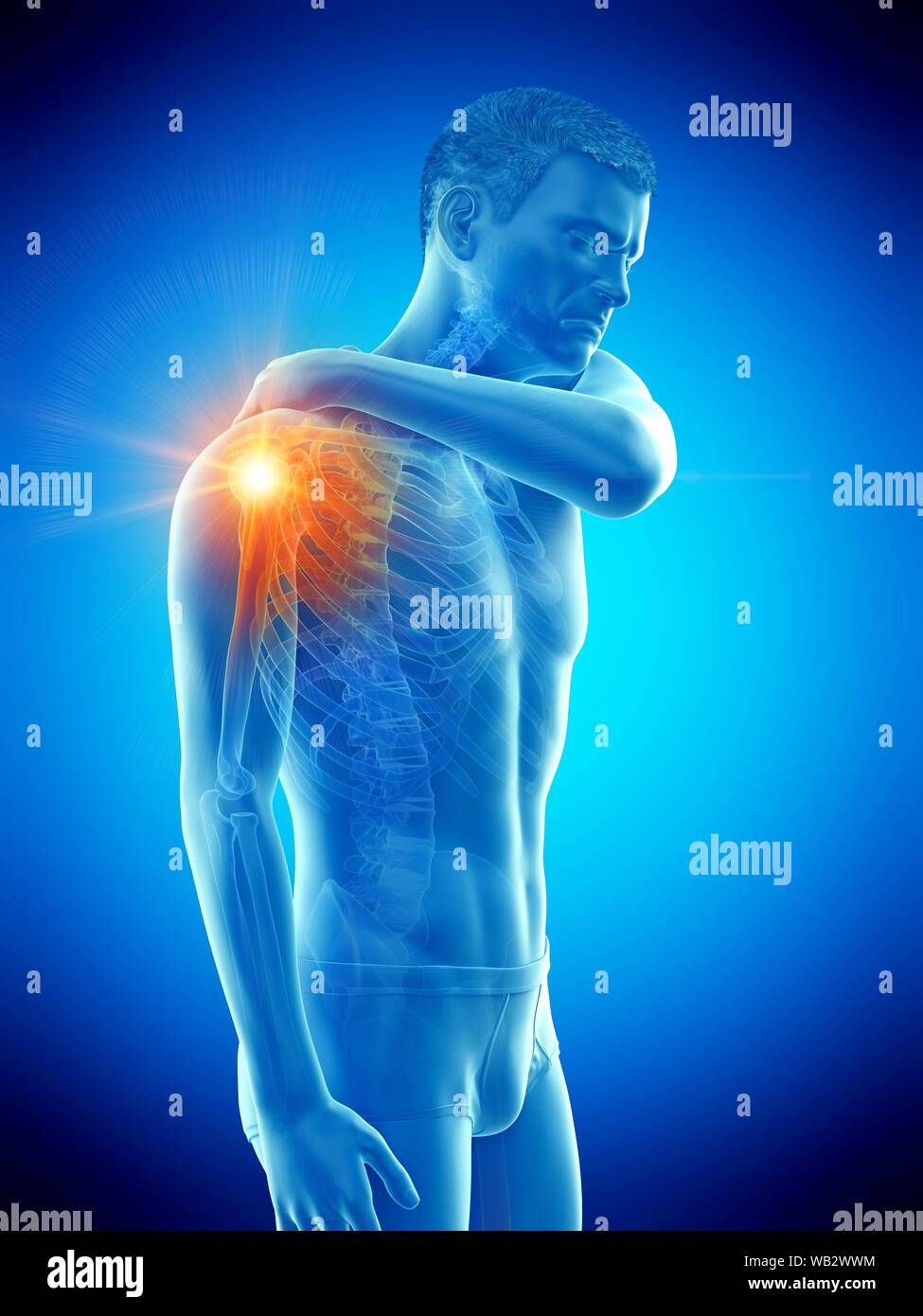 Shoulder pain, conceptual illustration Stock Photo - Alamy Shoulder pain, conceptual illustration Stock Photo - Alamy
