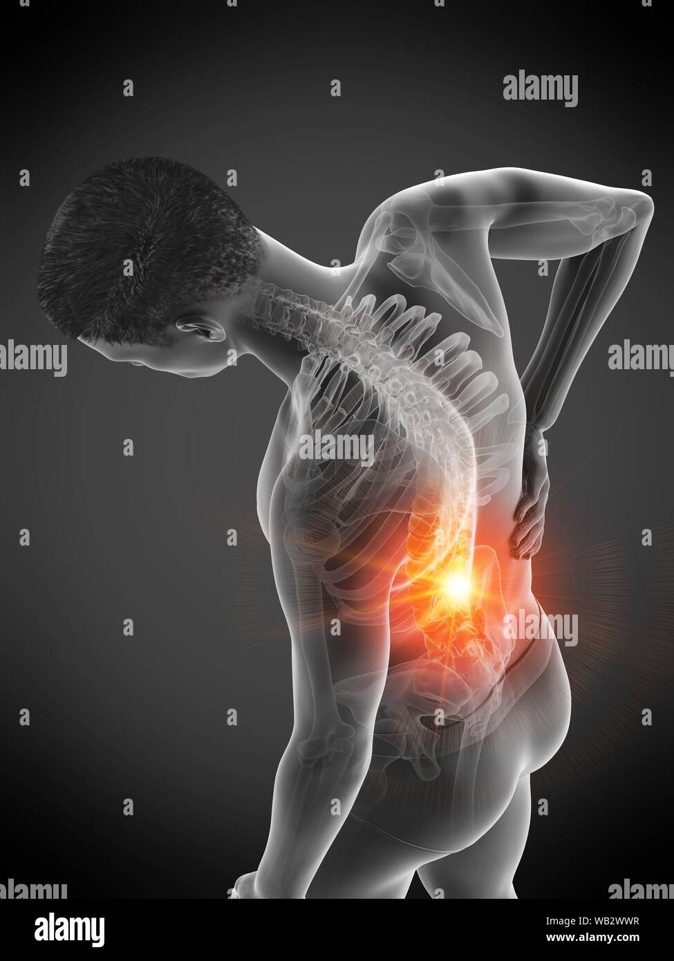 Back pain, conceptual illustration Stock Photo - Alamy