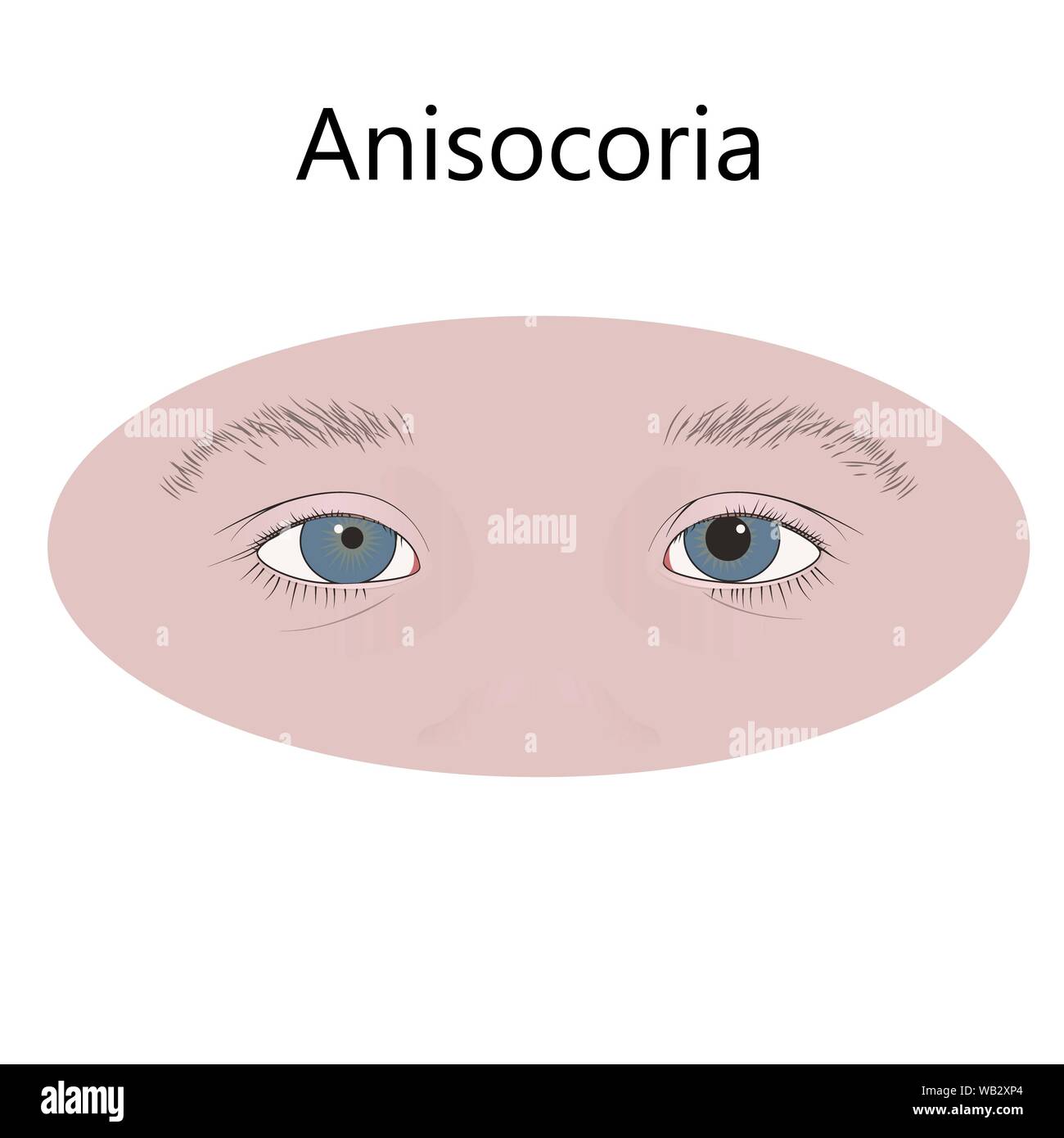 Anisocoria