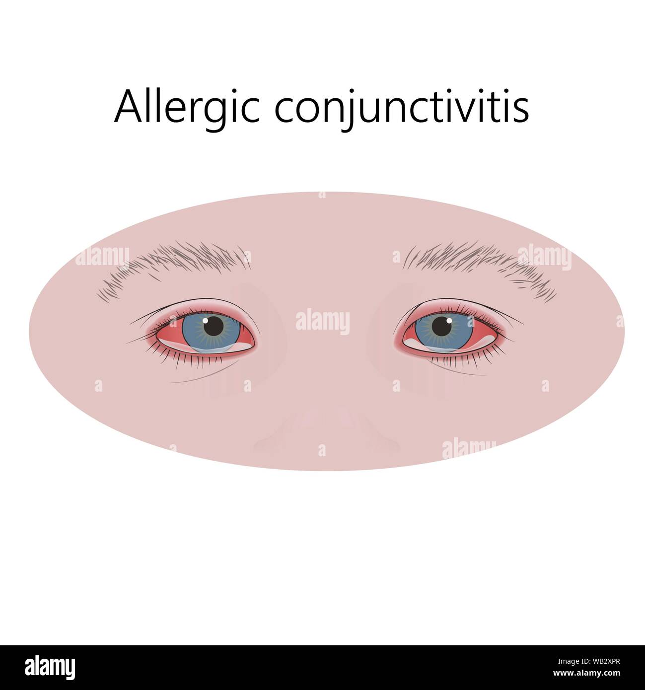 Allergic conjunctivitis hi-res stock photography and images - Alamy