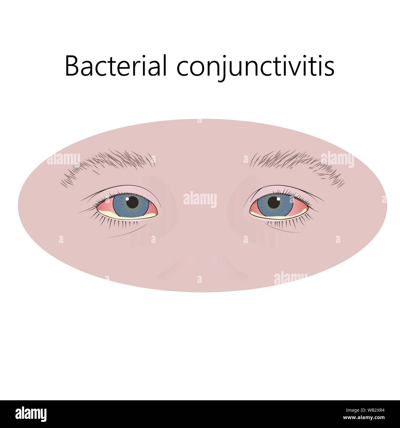 Bacterial conjunctivitis, illustration Stock Photo - Alamy