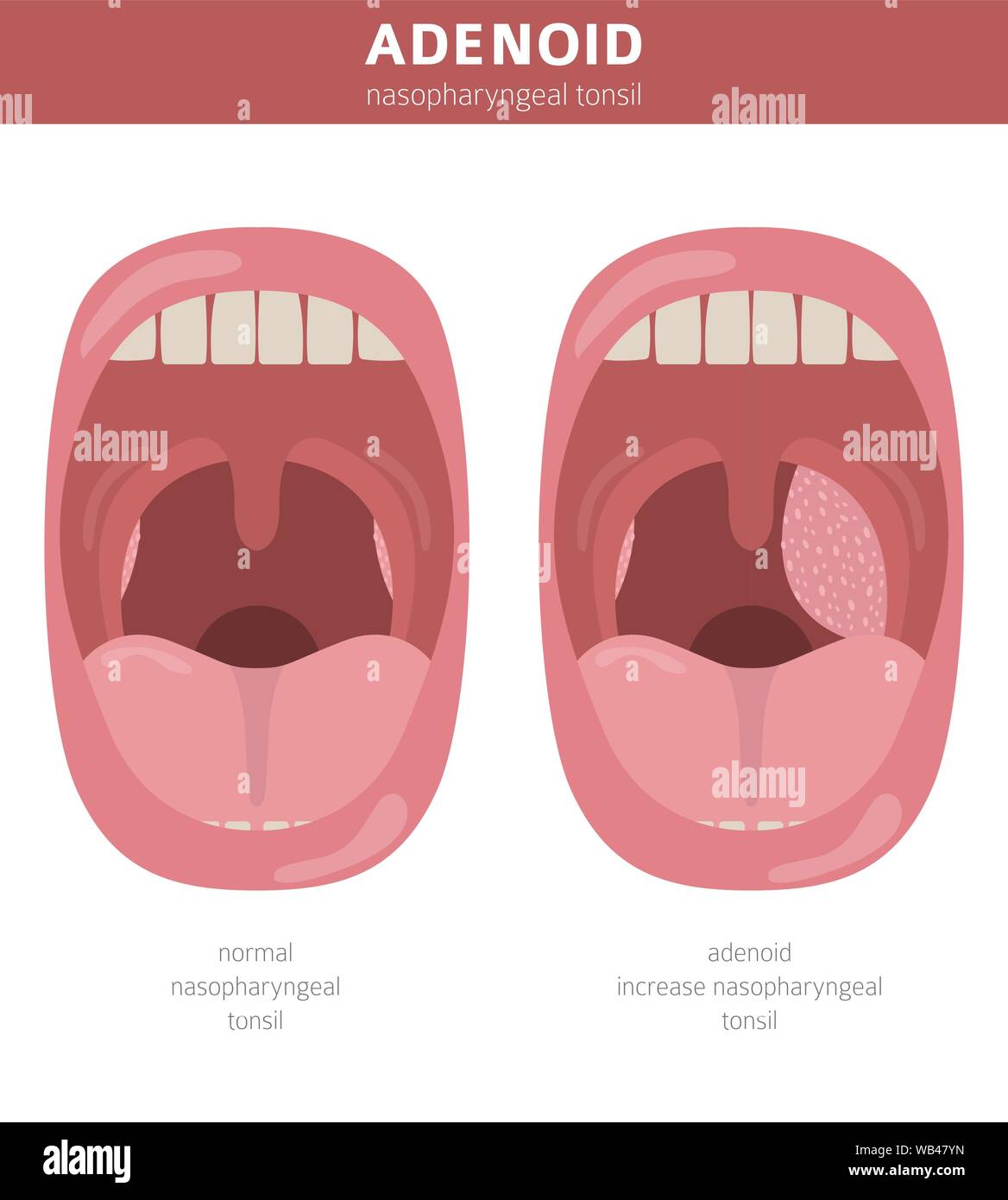 Nasopharynx vector vectors hi-res stock photography and images - Alamy