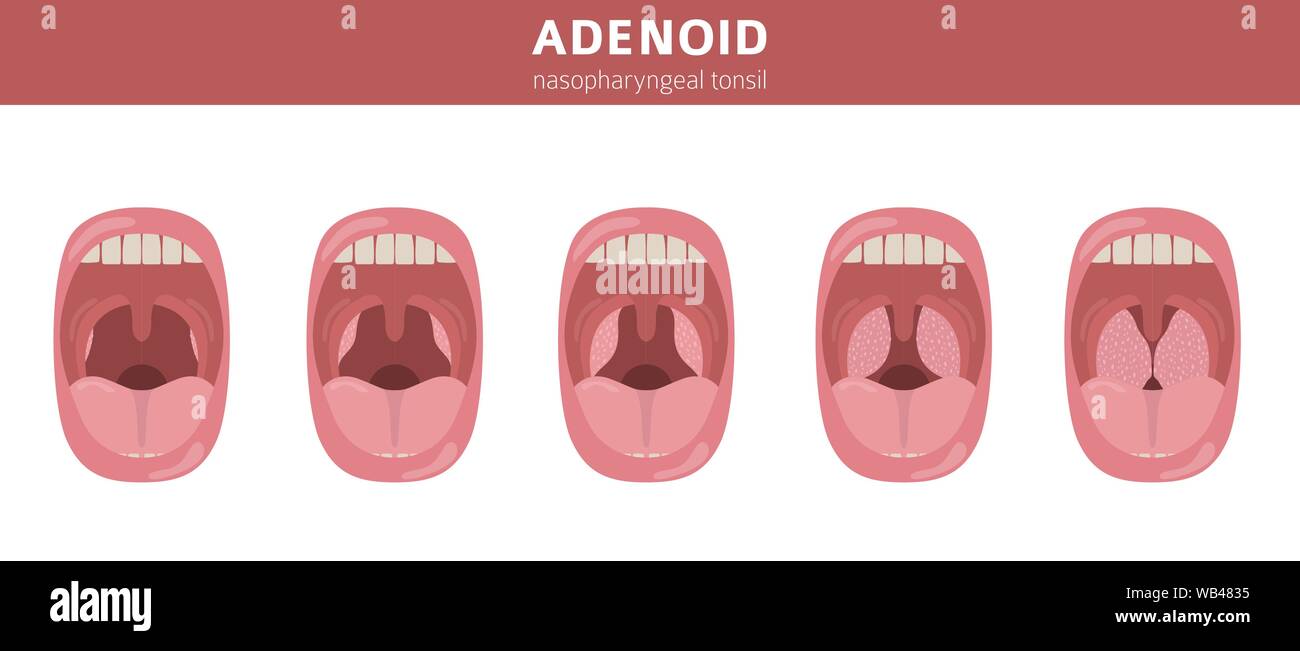 Nasal and throat, nasopharynx diseases. Adenoids diagnosis and treatment medical infographic ...