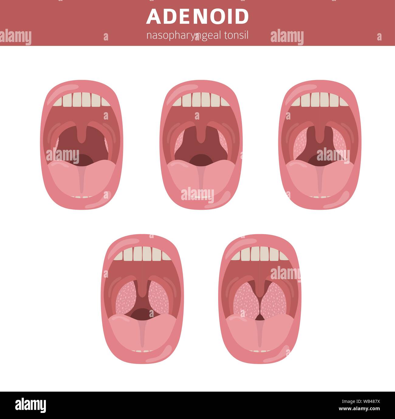 Swollen Adenoids