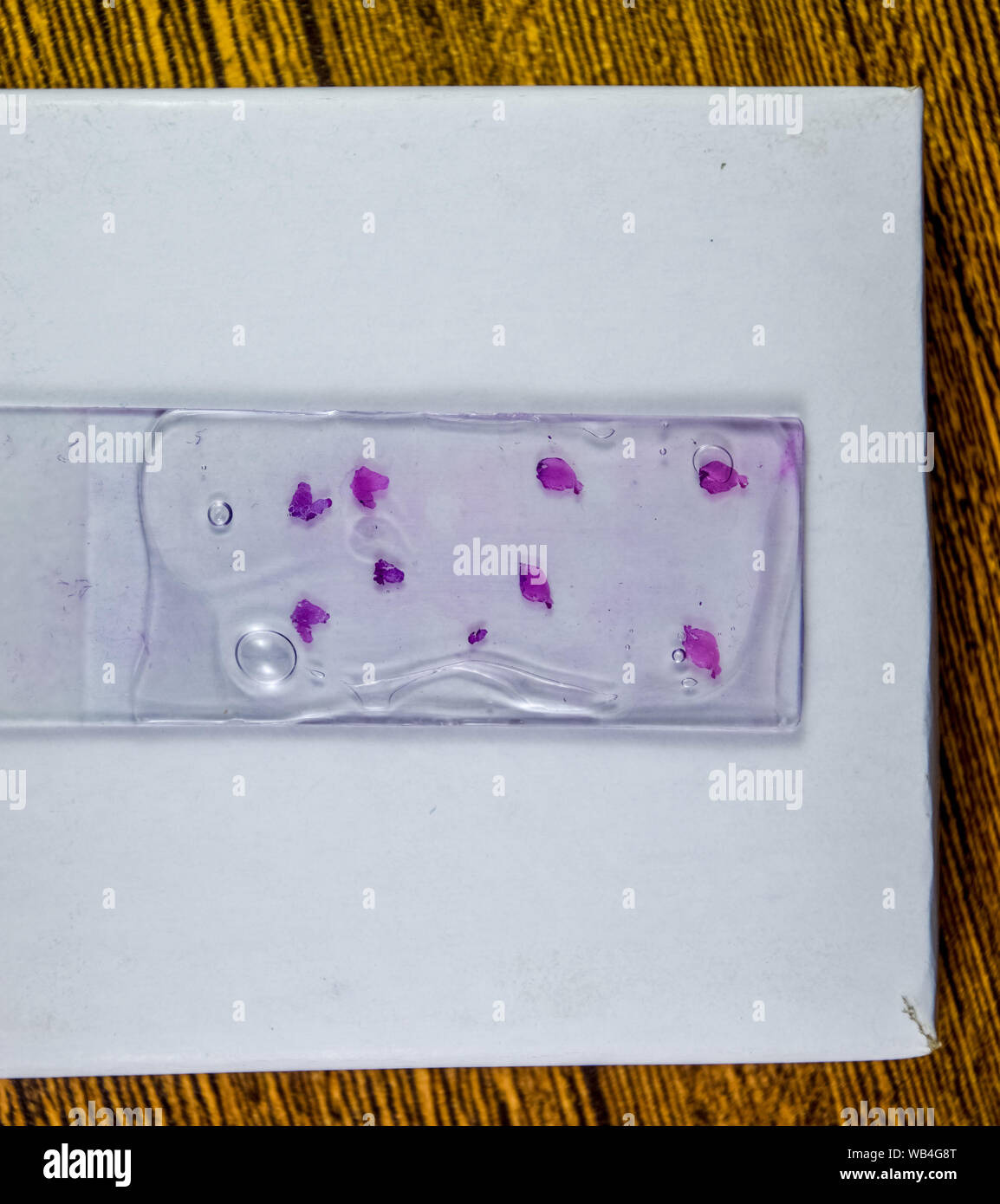 Slices of the tumor under glass. Histological examination of tumor ...
