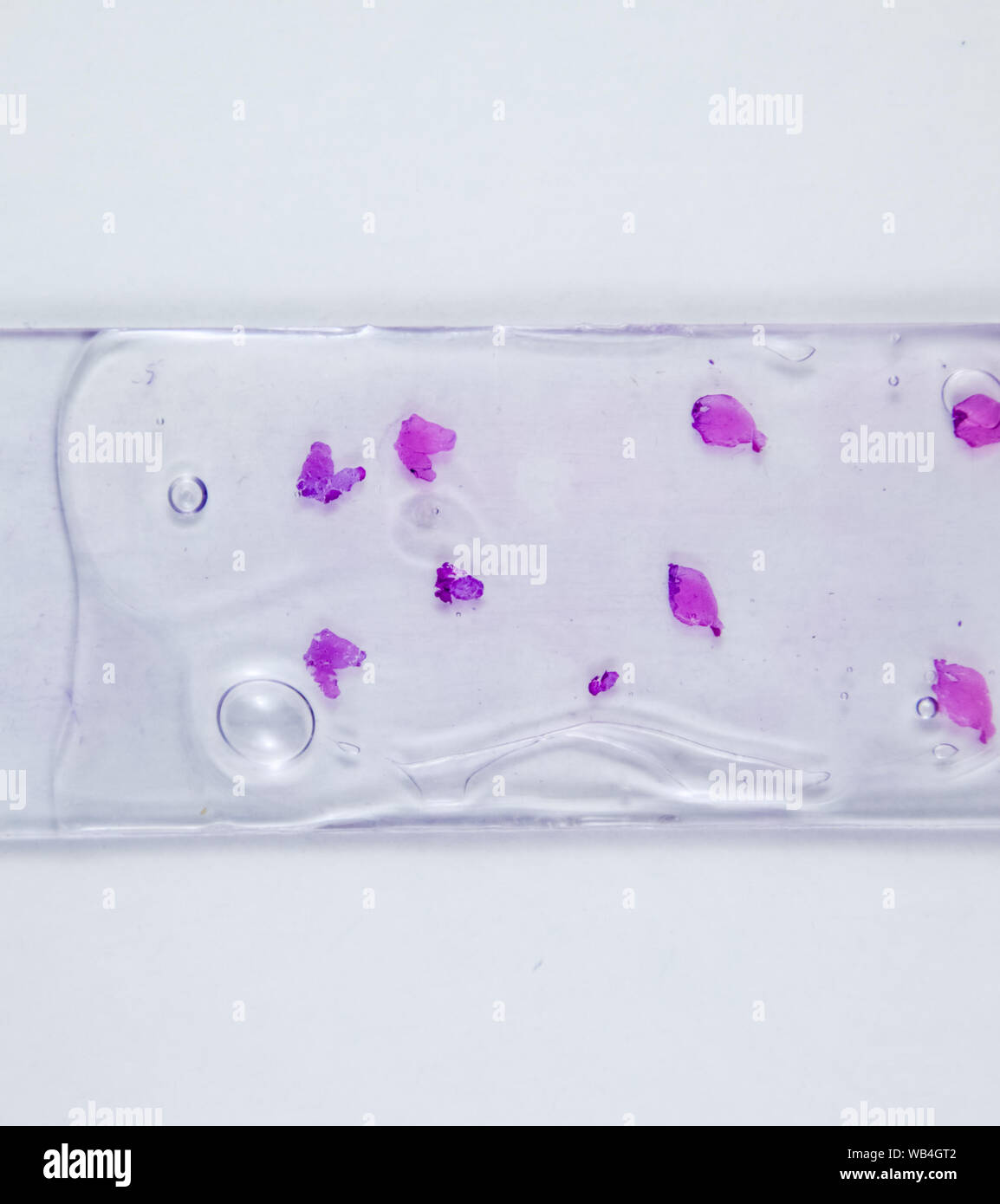 Slices of the tumor under glass. Histological examination of tumor ...