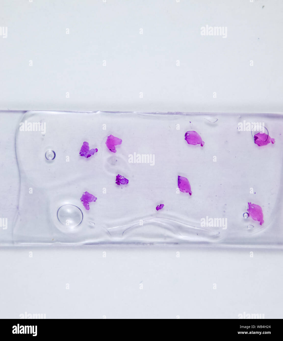 Malignant melanoma micrograph hi-res stock photography and images - Alamy