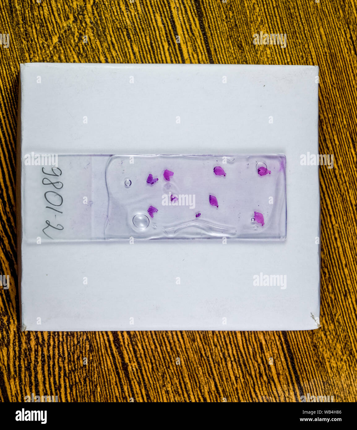 Slices of the tumor under glass. Histological examination of tumor ...
