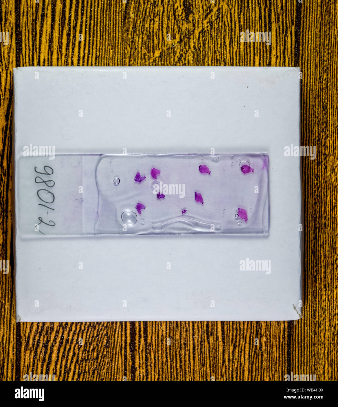 Slices of the tumor under glass. Histological examination of tumor ...
